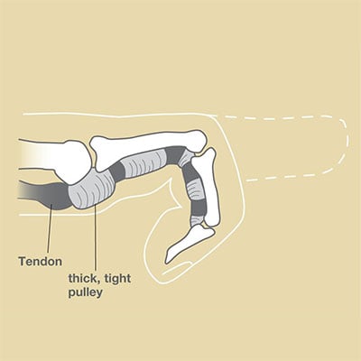Trigger Finger | Orthopaedic Associates of Wausau